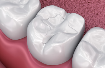 White / Composite Fillings - Pedro Arteche | Dentist in Central London